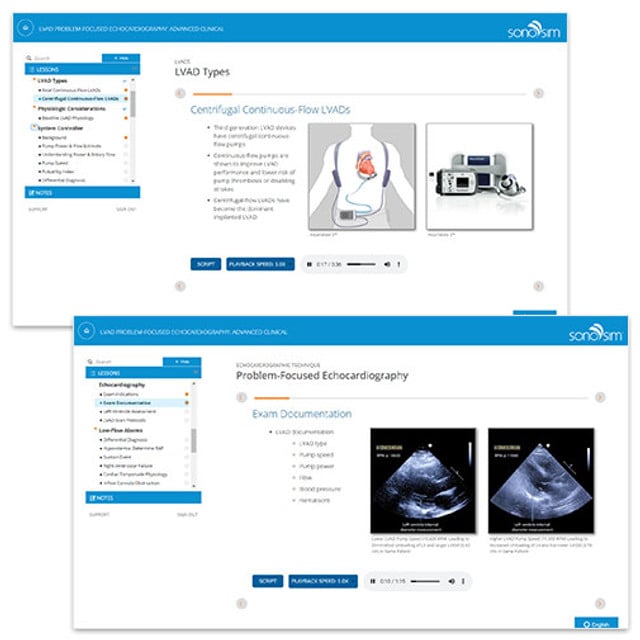 LVAD Problem-Focused Echocardiography Advanced Clinical Ultrasound Training | SonoSim