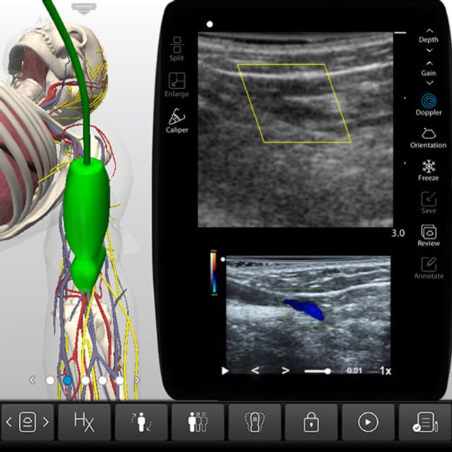 Vascular Mapping for Preoperative Planning of Dialysis Access Advanced ...
