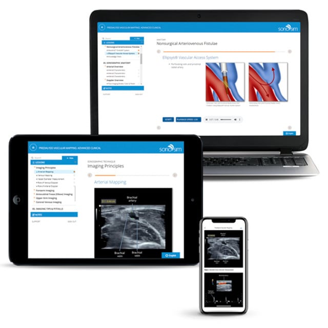 Vascular Mapping for Preoperative Planning of Dialysis Access Advanced ...