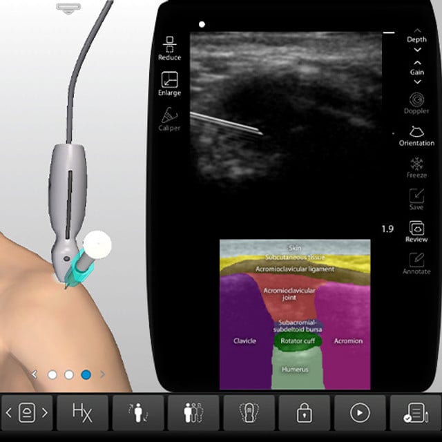 Acromioclavicular Joint Injection & Aspiration Ultrasound-Guided ...