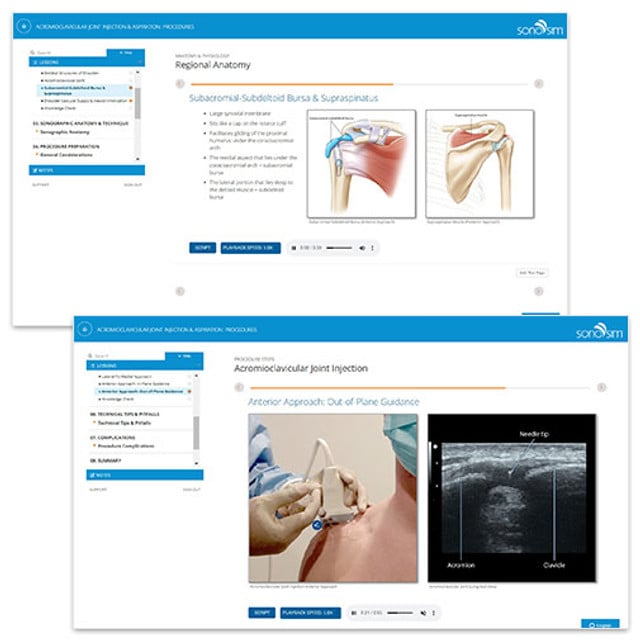 Acromioclavicular Joint Injection & Aspiration Ultrasound-Guided ...