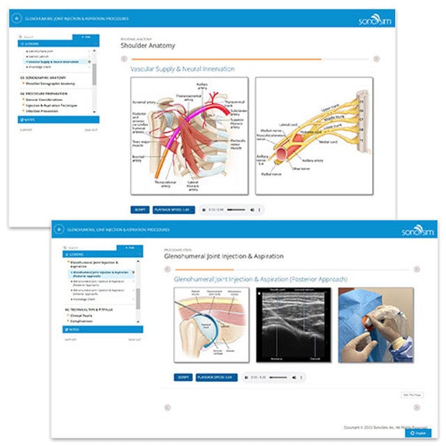 Glenohummeral Joint Injection & Aspiration Procedure | SonoSim