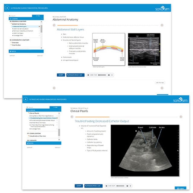 Ultrasound-Guided Paracentesis Procedure Training | SonoSim