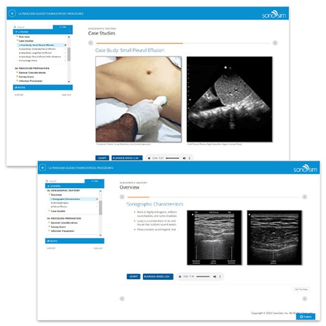 Ultrasound-Guided Thoracentesis Procedure Training | SonoSim